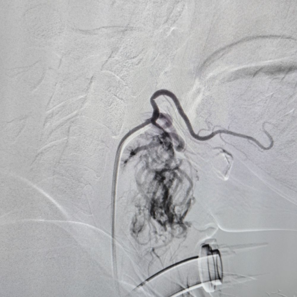 Embolization Therapies - Dr. Akash Bansal